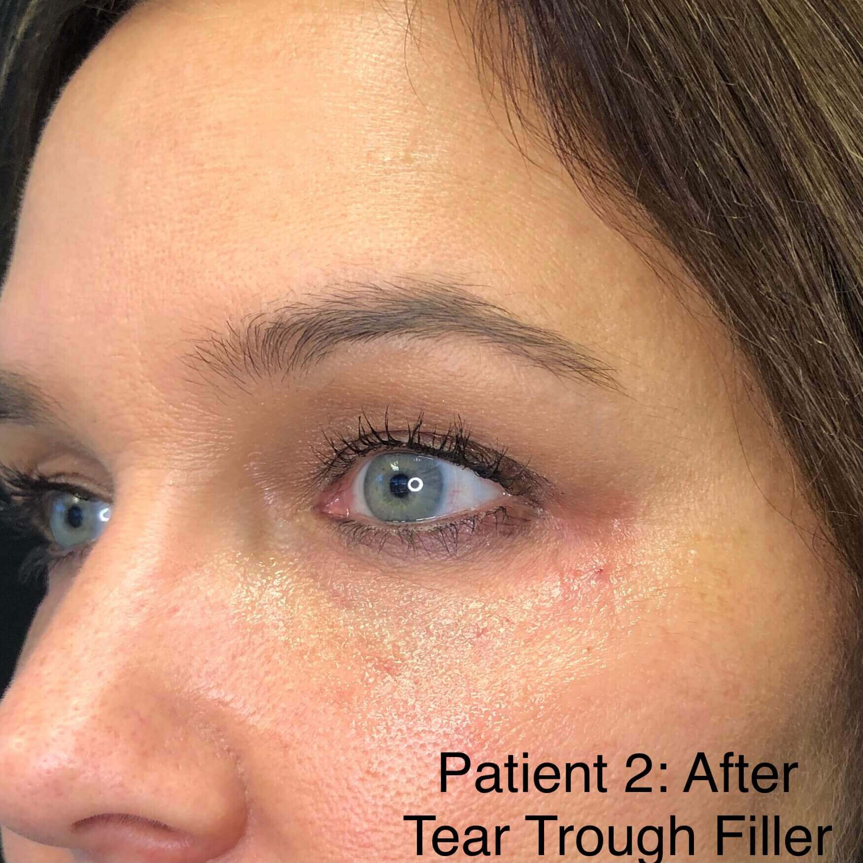 Austin Cosmetic Injectables Treatments | Dr. Anthony Bittar